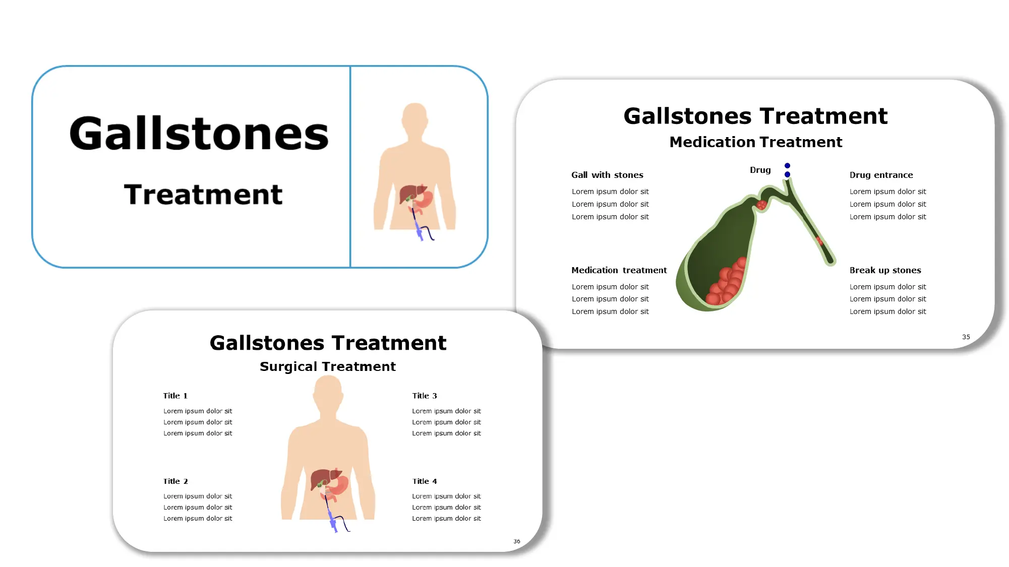 Download Gallstones PowerPoint Template| RxSlides